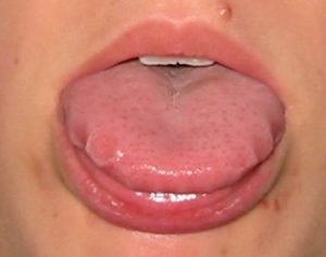 Why Do I Have Wavy Tongue Edges? · PrepScholar